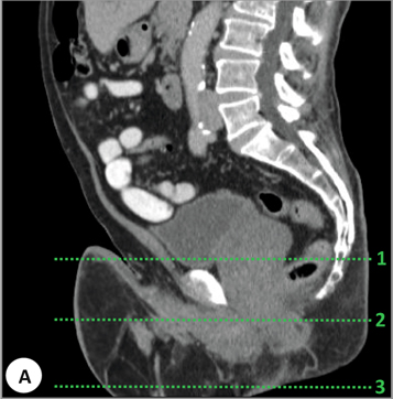 Case report. Liposarcoom van het scrotum | SpringerLink