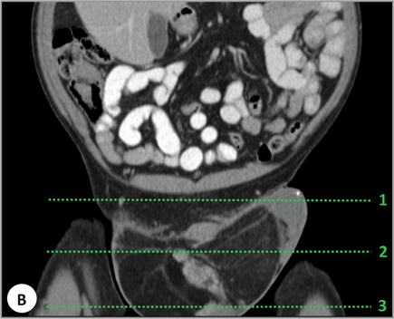 Case report. Liposarcoom van het scrotum | SpringerLink