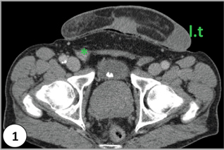 Case report. Liposarcoom van het scrotum | SpringerLink