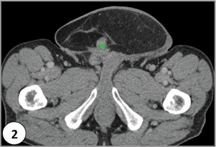 Case report. Liposarcoom van het scrotum | SpringerLink