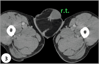 Case report. Liposarcoom van het scrotum | SpringerLink