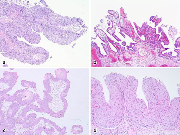 Blaaskankerpathologie: van cystoscoop naar microscoop | SpringerLink