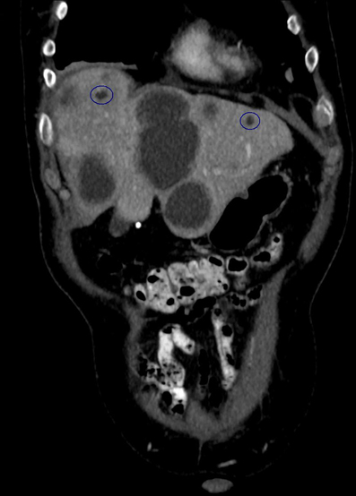 Case report. Atypische, cysteuze levermetastasen bij een ...