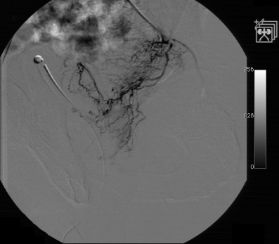 Selectieve embolisatie van de arteria prostatica met curatieve intentie ...