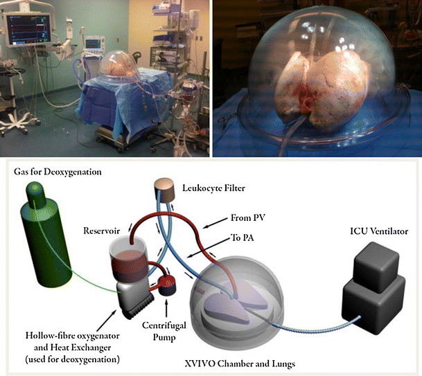 Ex vivo lung perfusion (EVLP) | SpringerLink
