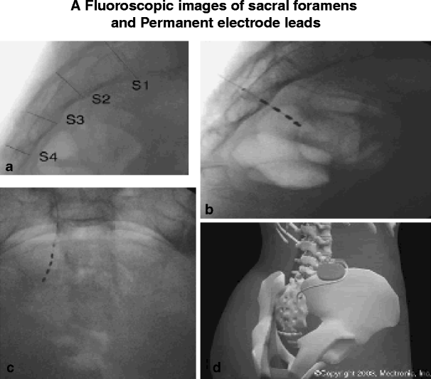 The Role of Sacral Nerve Stimulation in Female Pelvic Floor Disorders ...