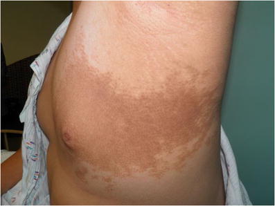 Update on Epidermal Nevi and Associated Syndromes | SpringerLink