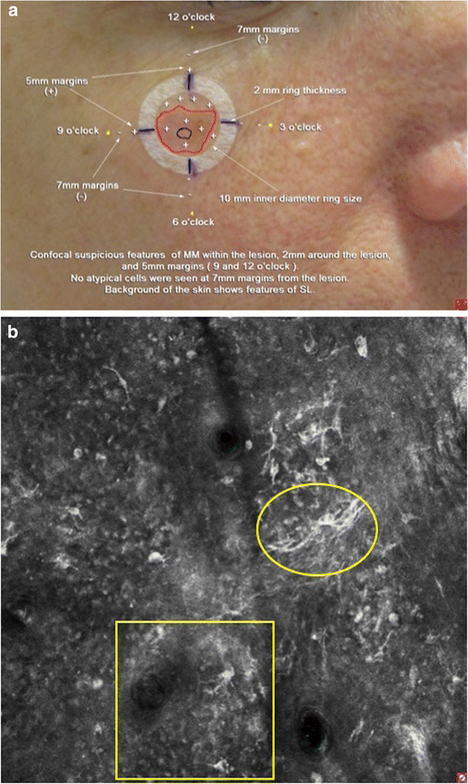 Reflectance Confocal Microscopy for Skin Cancer Margins: How it Works ...