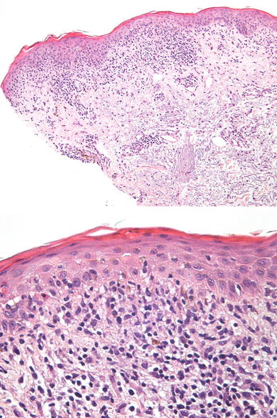Photosensitivity reaction induced by erlotinib | SpringerLink