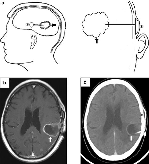 Cystic brain metastasis of non-small-cell lung cancer successfully ...