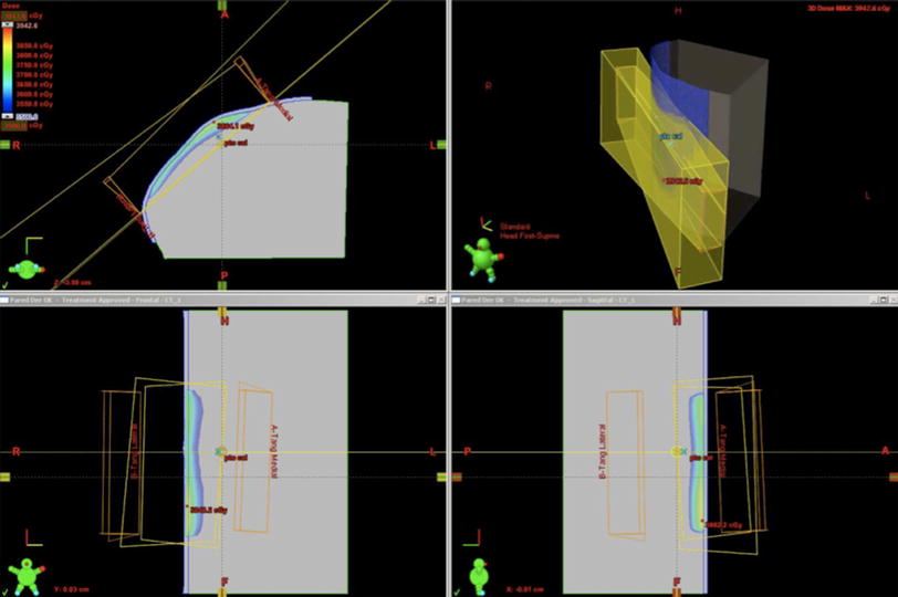 Radiation recall dermatitis: report of two cases | SpringerLink