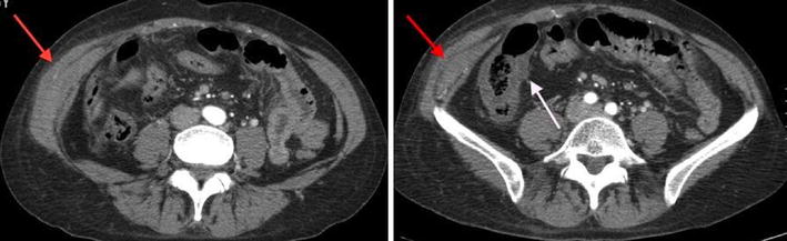 Radiation recall dermatitis: report of two cases | SpringerLink