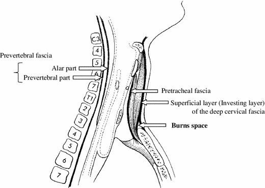 Lymph node metastasis in the suprasternal space from thyroid papillary ...
