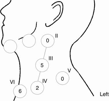 Lymph node metastasis in the suprasternal space from thyroid papillary ...