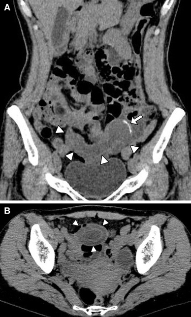 A case of low-grade appendiceal mucinous neoplasm with invagination ...