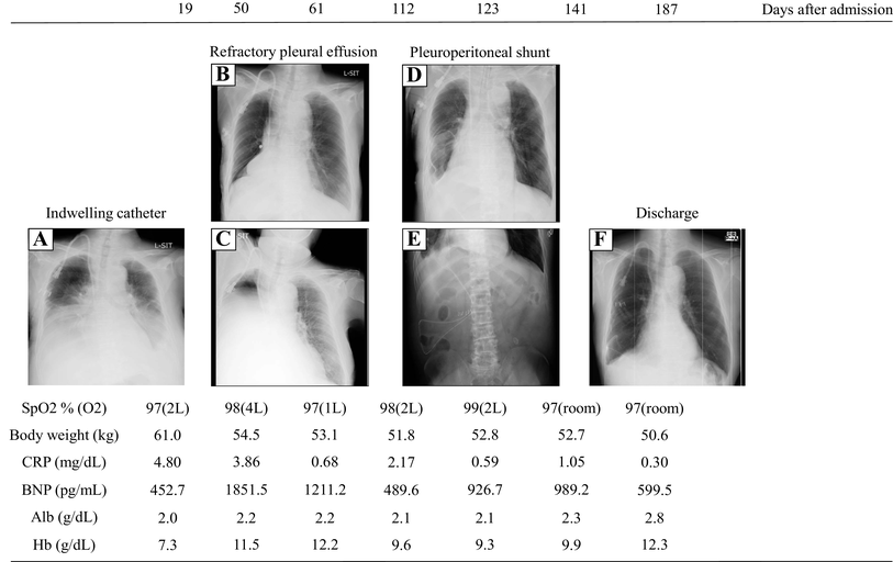 Usefulness of a pleuroperitoneal shunt for treatment of refractory ...
