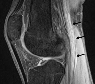 Knee MRI showing thickened peripheral nerves in Charcot–Marie–Tooth ...