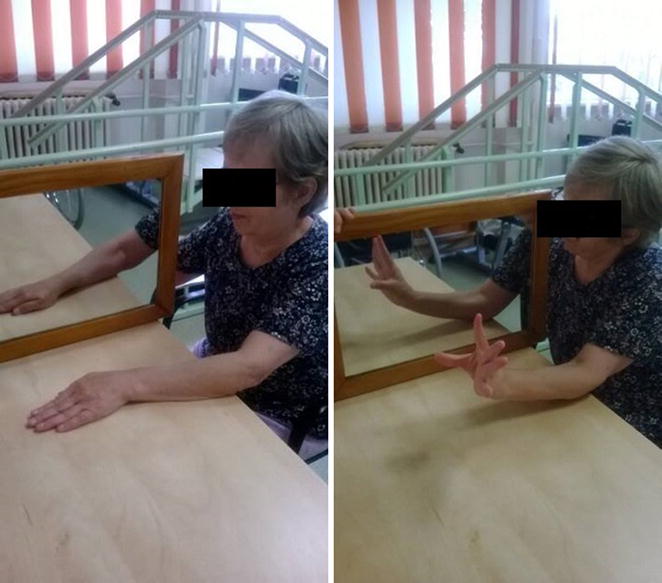 Mirror therapy enhances upper extremity motor recovery in stroke ...