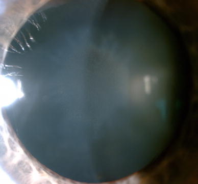 The sunflower cataract in Wilson’s disease: pathognomonic sign or rare ...