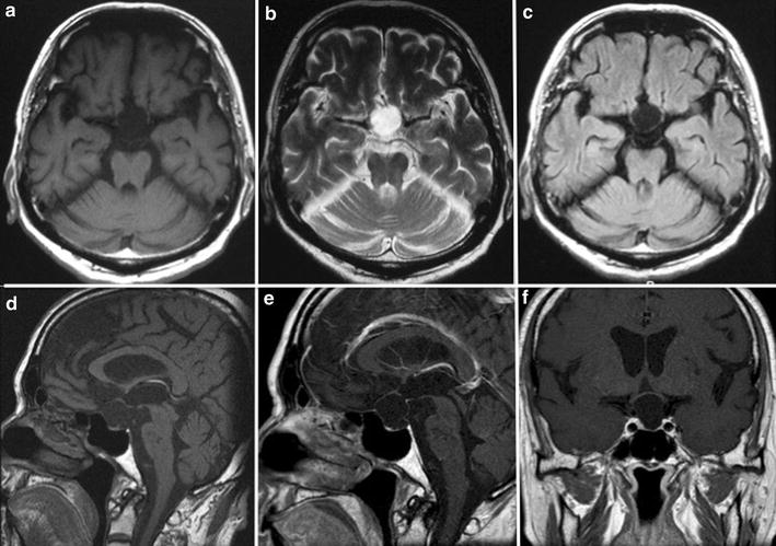 A case of Rathke cleft cyst concomitant with sellar/suprasellar ...
