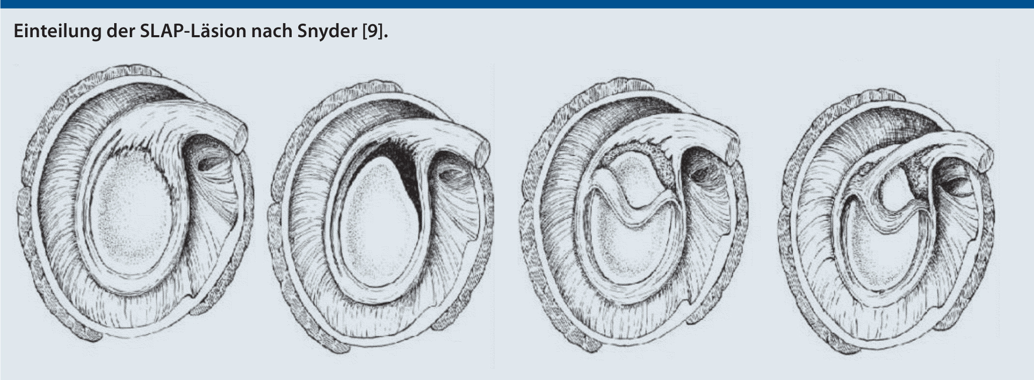 SLAP-Läsion der Schulter: Verletzungsmuster bestimmt Therapie ...
