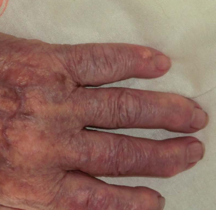 Gicht ist mehr als nur Podagra | SpringerLink