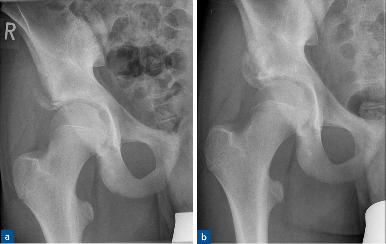 Aktuelle Therapie von Frakturen im Kindes- und Jugendalter | SpringerLink