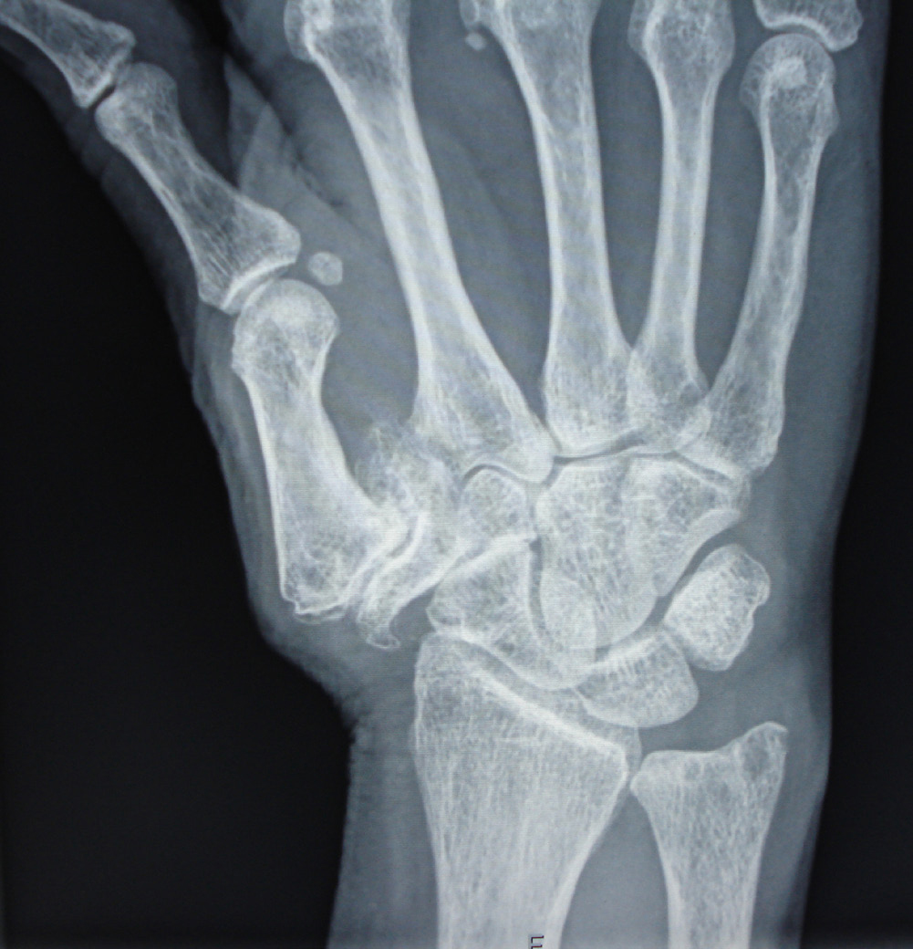 Stadiengerechte Rhizarthrose-Therapie | SpringerLink