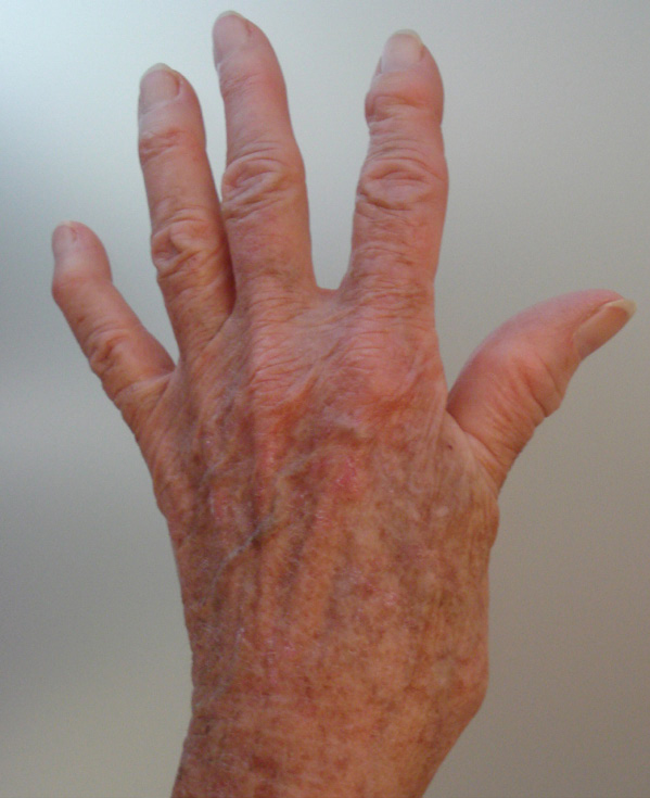 Stadiengerechte Rhizarthrose-Therapie | SpringerLink