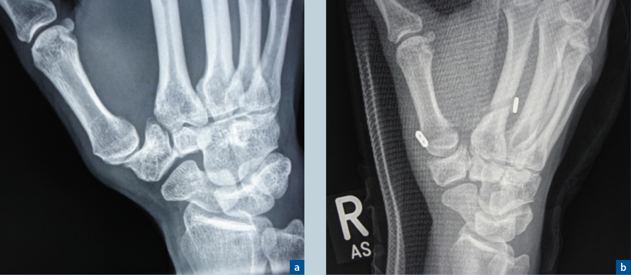 Stadiengerechte Rhizarthrose-Therapie | SpringerLink