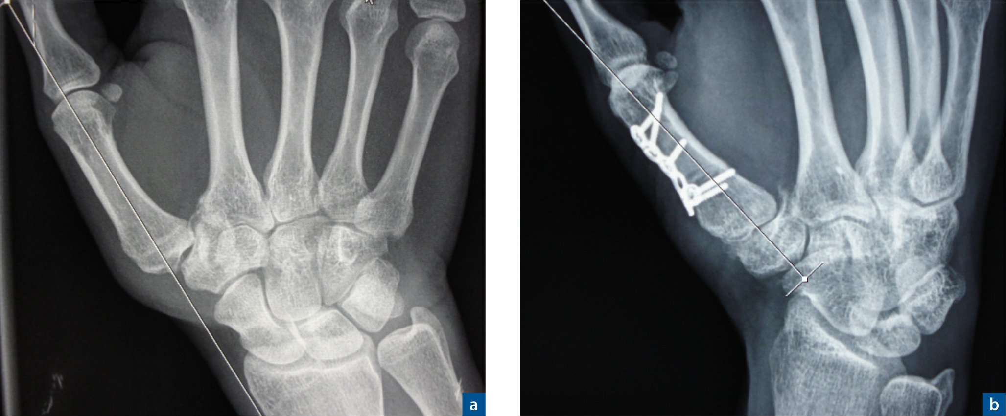 Stadiengerechte Rhizarthrose-Therapie | SpringerLink