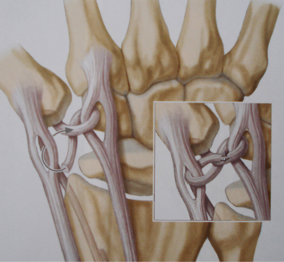 Stadiengerechte Rhizarthrose-Therapie | SpringerLink