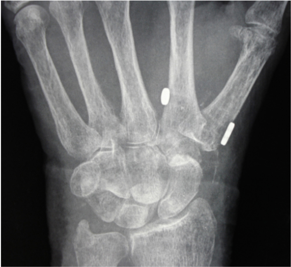 Stadiengerechte Rhizarthrose-Therapie | SpringerLink