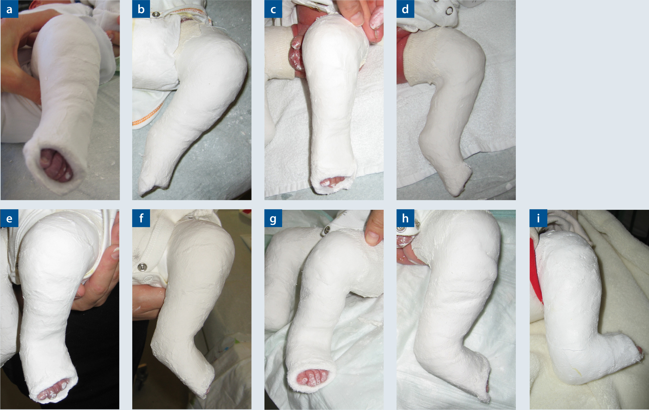 Therapie nach Ponseti: Goldstandard bei kongenitalen Klumpfüßen ...