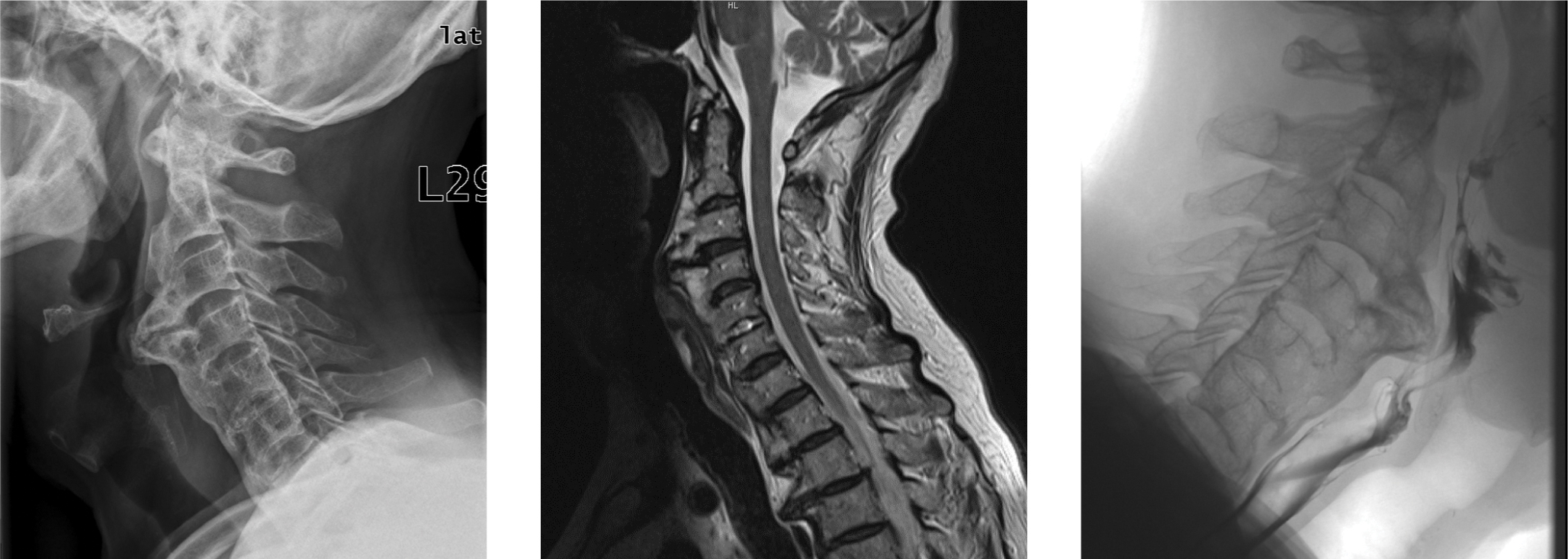 Entzündliche Erkrankungen der HWS: selten, aber komplikationsträchtig ...