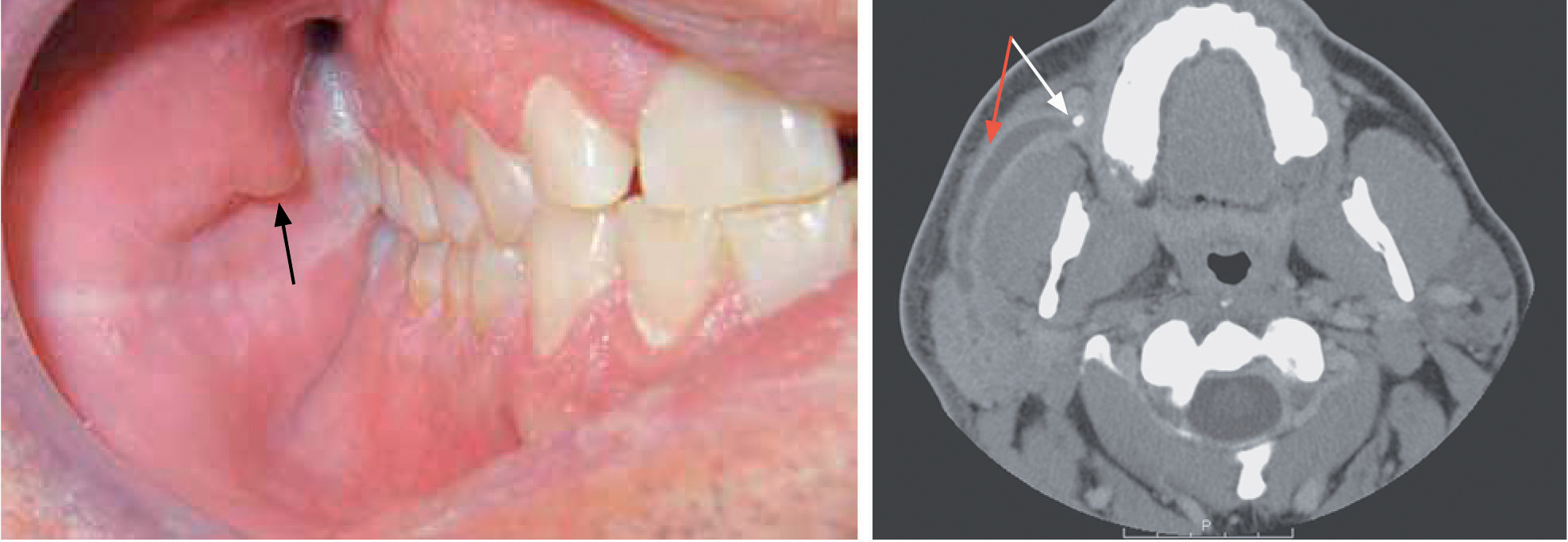 Obstruktive Parotitis | SpringerLink