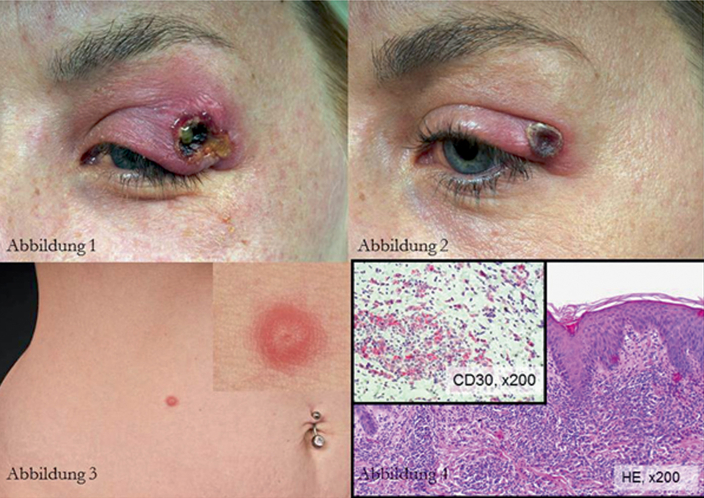 Herpes? Lues? Neoplasie? | SpringerLink