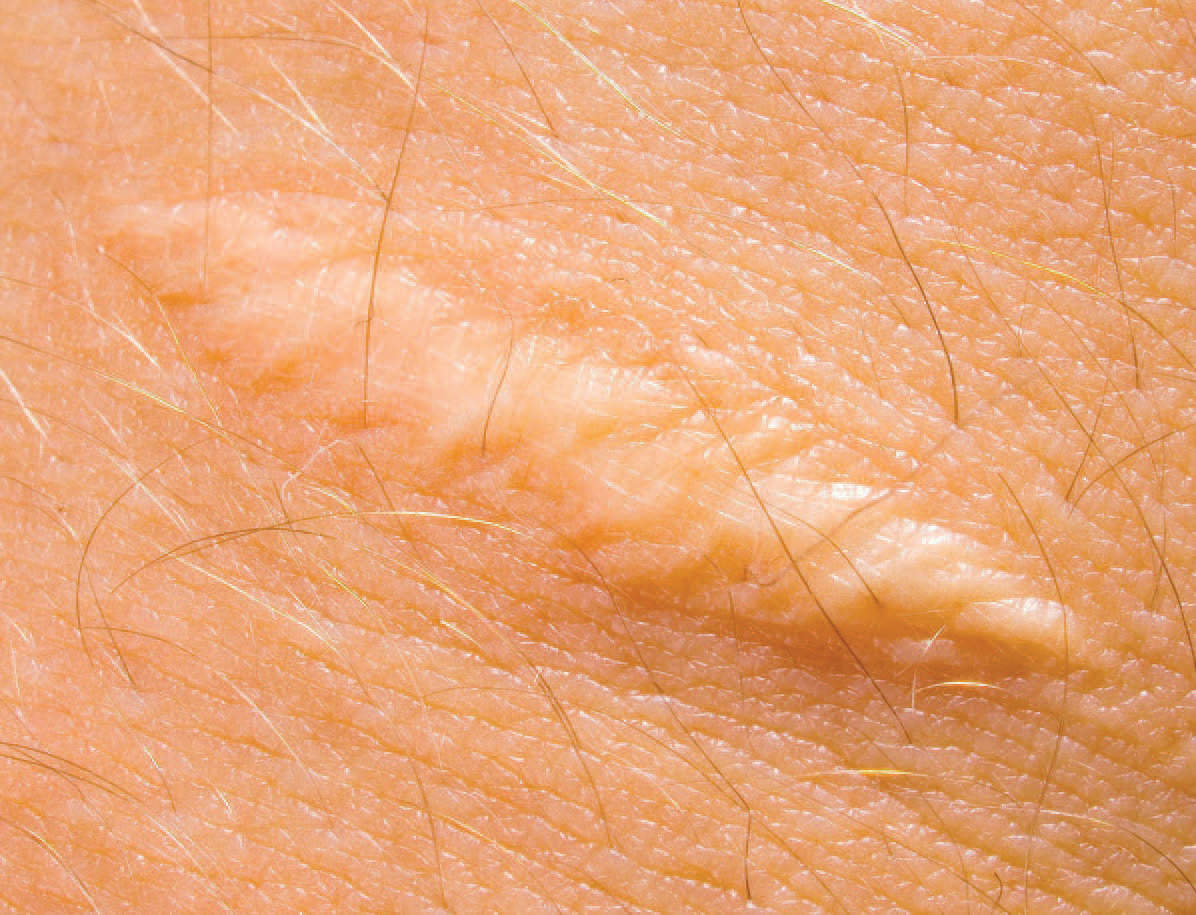 Was wulstige Narben „plattmacht“ | SpringerLink