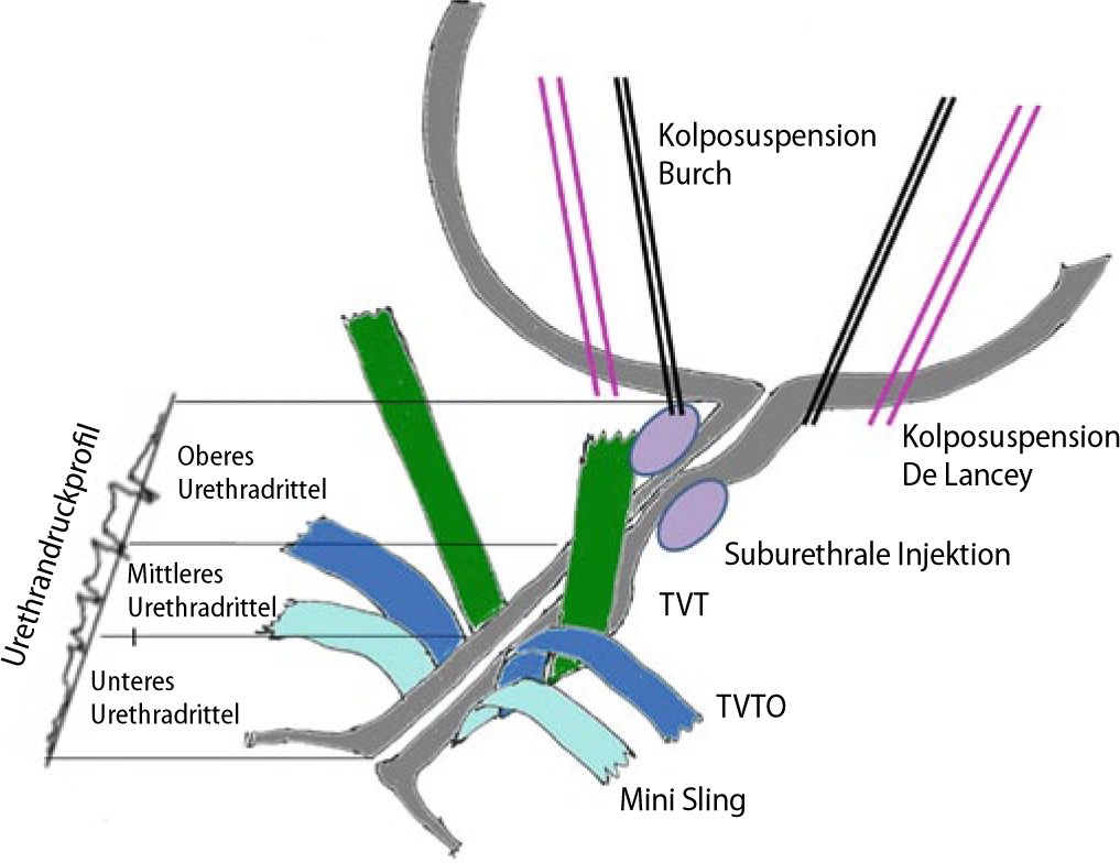 Immer noch ein Tabuthema? | SpringerLink