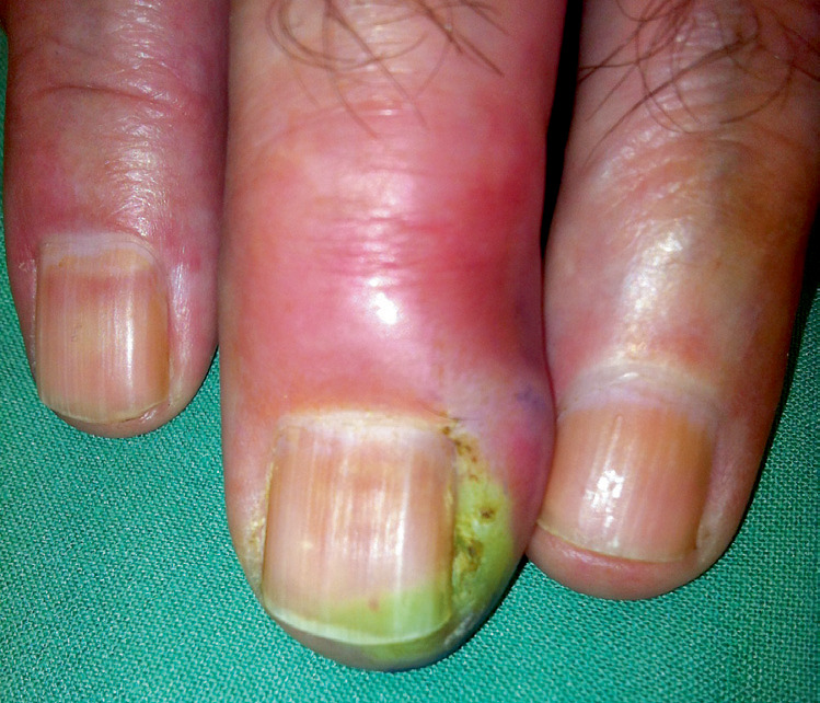 Handphlegmone | SpringerLink