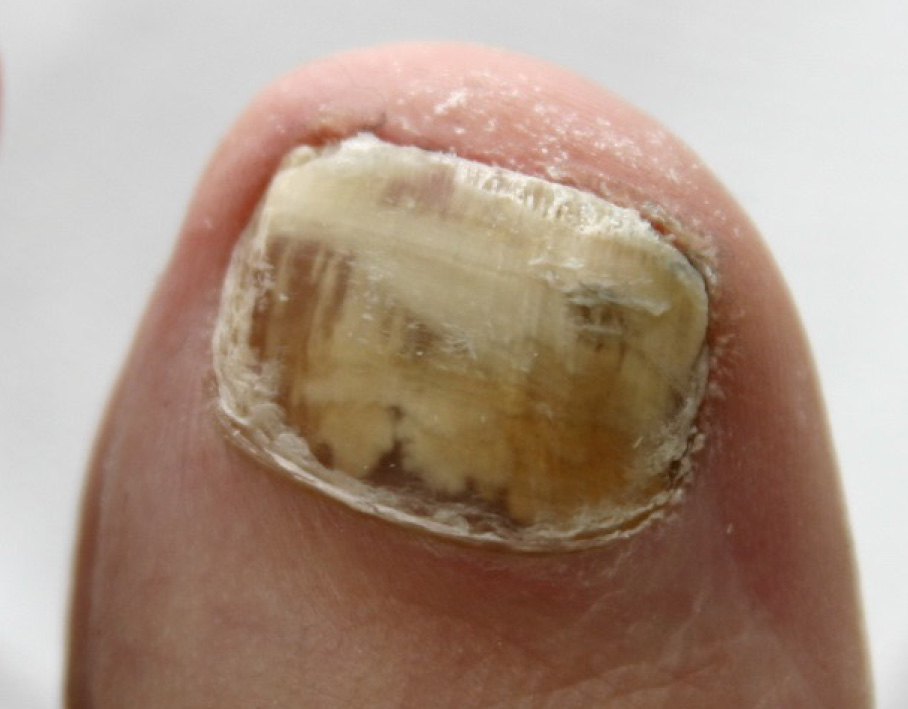 Mykosen der Haut | SpringerLink