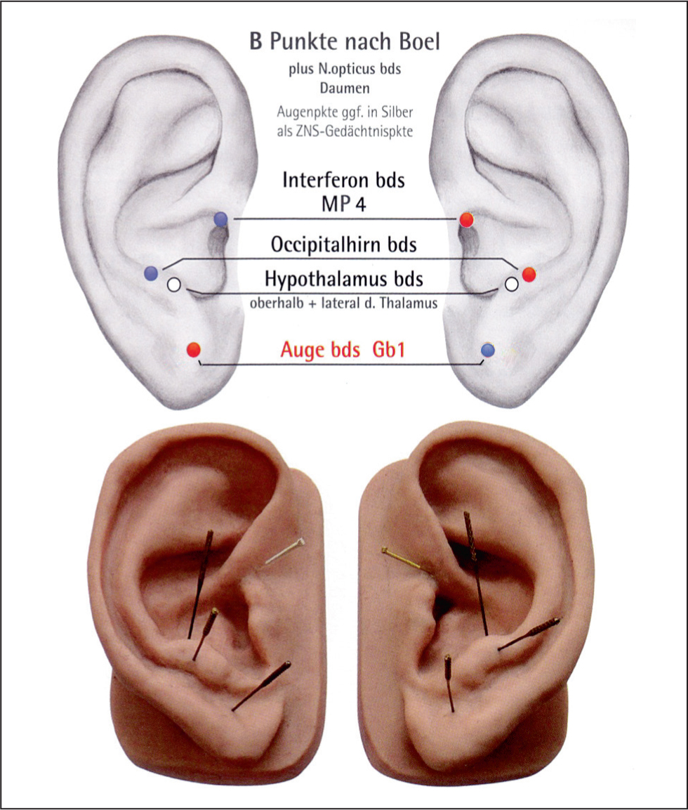 AKUPUNKTUR IN DER AUGENHEILKUNDE – TEIL 1 | SpringerLink