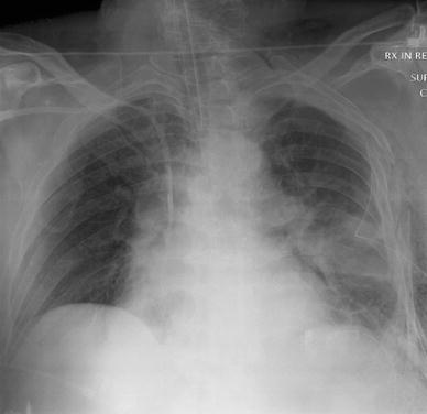 Septic shock, pneumonia, and soft tissue infection due to Myroides ...