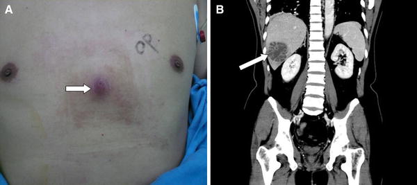 Metastatic Abscess Formation In A Preexisting Chest Wall Tumor A Rare Initial Presentation Of