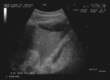 Tubercular liver abscess: an uncommon presentation of disseminated ...