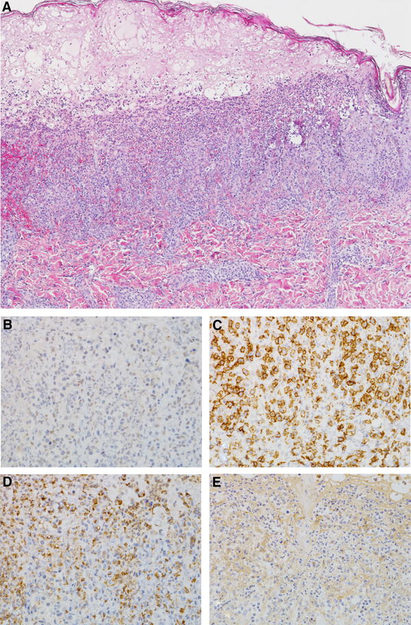 Febrile ulceronecrotic Mucha–Habermann disease following suspected ...