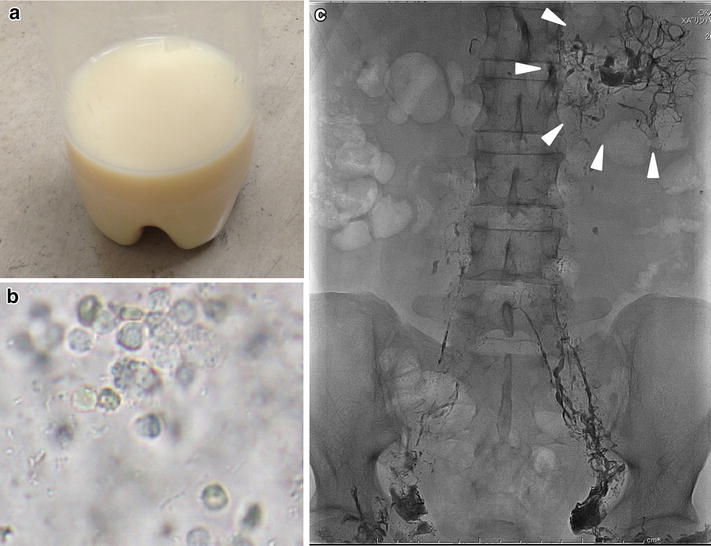 Refractory chyluria due to filariasis | SpringerLink