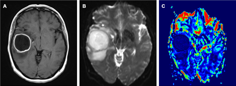 Pyogenic brain abscess and subdural empyema: presentation, management ...