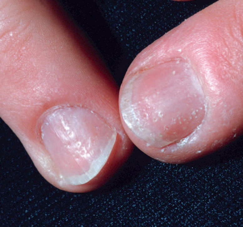 Was die „Muster“ auf den Nägeln verraten | SpringerLink