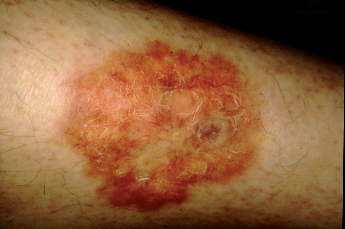 Wie Diabetes der Haut zusetzt | SpringerLink